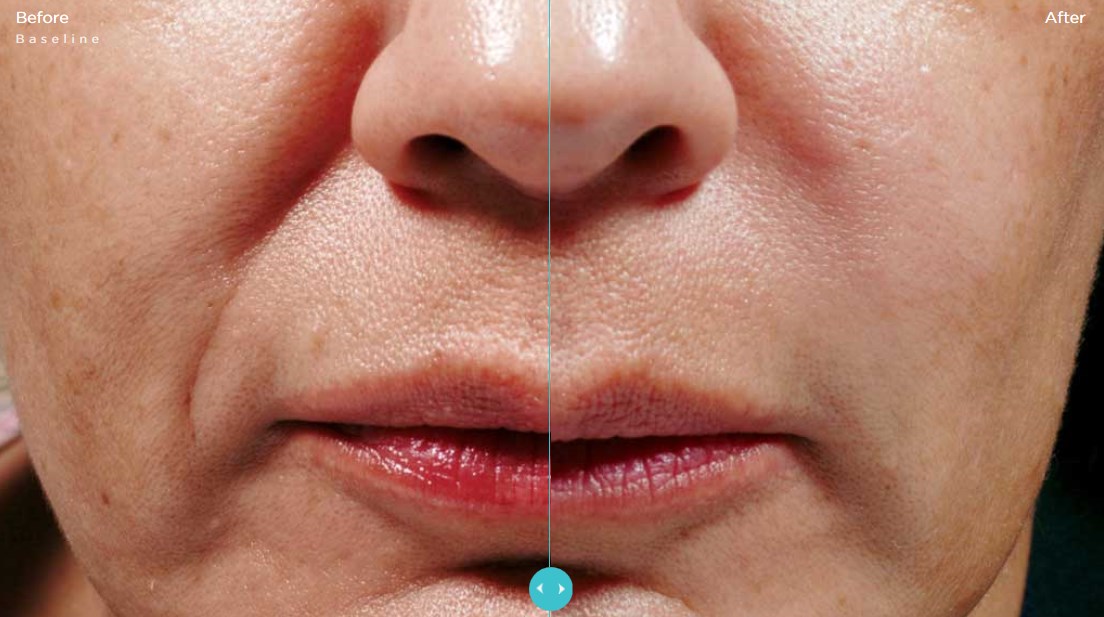 Bellafill ® - Debra Tanner Abell, MD