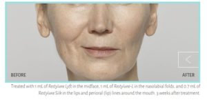 Restylane Lyft - Debra Tanner Abell, MD