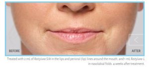 Restylane Silk - Debra Tanner Abell, MD