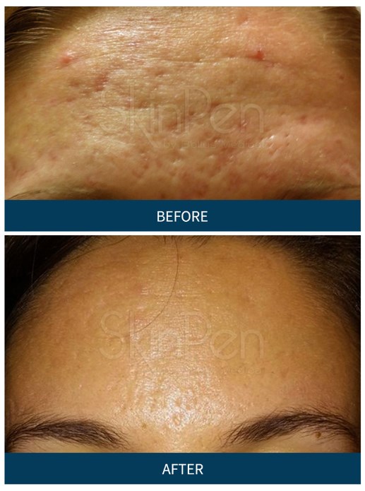 Microneedling with SkinPen® - Debra Tanner Abell, MD | Wexford, PA